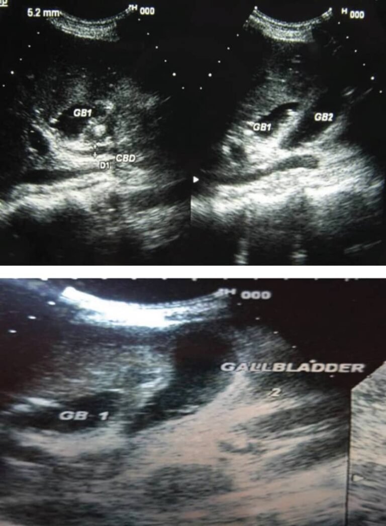 Gallbladder Duplication - A Rare Anomaly Detected